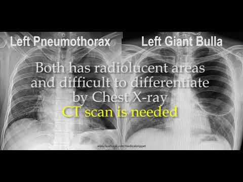 Pneumothorax vs Bulla in Chest X ray