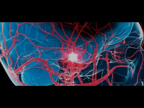 Revolutionary stroke treatment discovered - Tenecteplase offers new hope for stroke patients