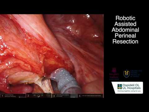 First Robotic APR in Ireland