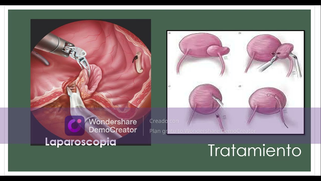 Divertículo vesical