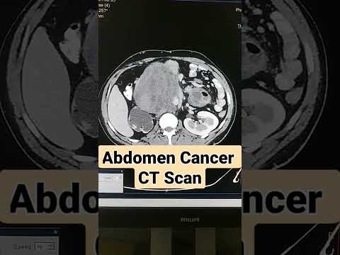 Abdomen Cancer Tomour #ct_scan #PET Scan