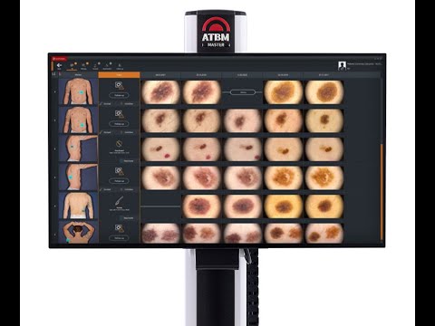 New Mole Gallery for your dermoscopy workflow