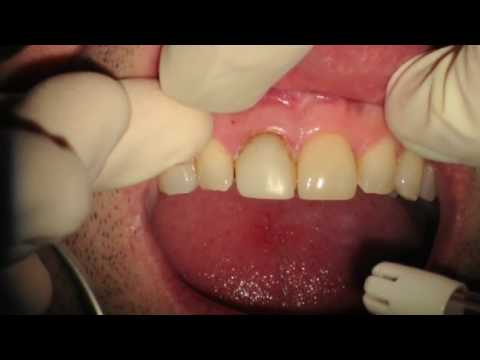 Gingival Recontouring for Esthetics with Picasso Lite