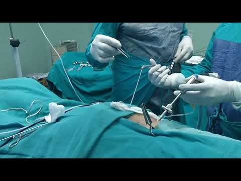 Slipped Disc Treatment Lower Back| Endoscopic Discectomy Stitchless Techniques | JPRC