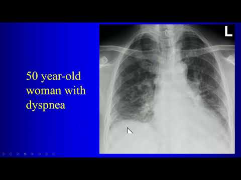 14b ILD P 2 Lower lung interstitial Disease