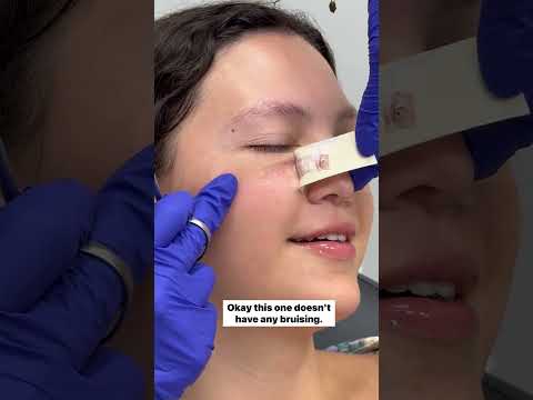 Removing Tape & Sutures - 1 Week Post Lower Blepharoplasty Surgery