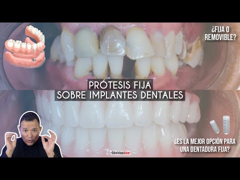Prótesis fija sobre Implantes dentales, 🔩 La mejor opción para volver a sonreír 🤔 -Odontología Láser