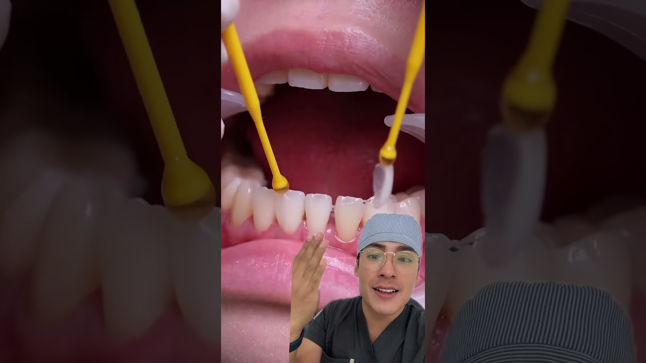 Dental veneers without tooth reduction #dentist #shorts