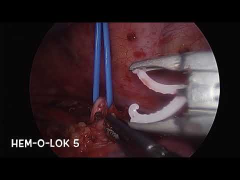 Thoracoscopic Repair of Vascular Ring Formed by Right Aortic Arch and Left Ligamentum Arteriosum