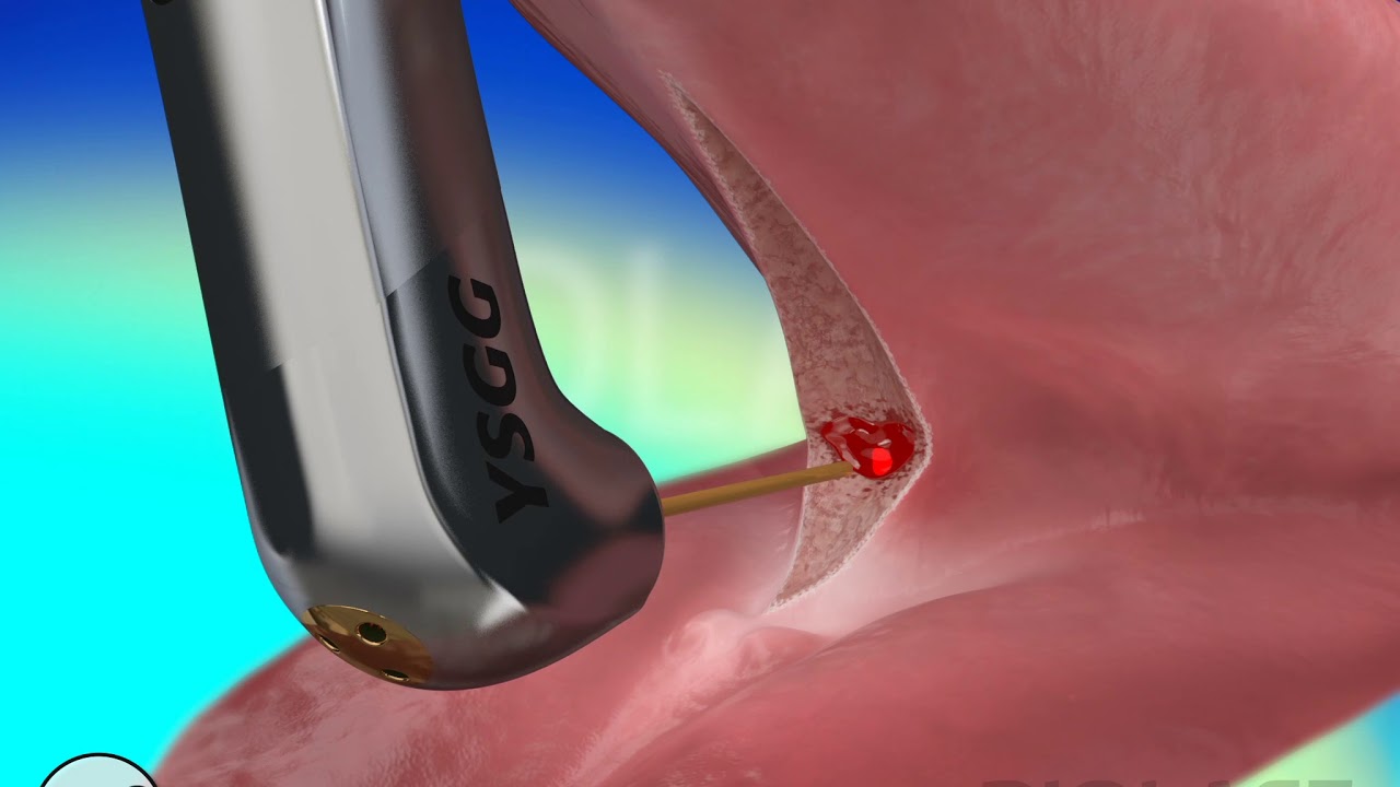 How tongue tie laser works