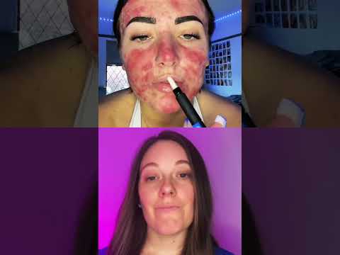 Embracing the Spots – Acne Positivity