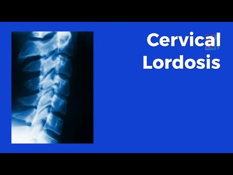 Cervical Lordosis – What Is It and What Is It And Why Is It Important ...