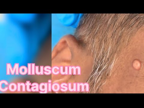Molluscum contagiosum
