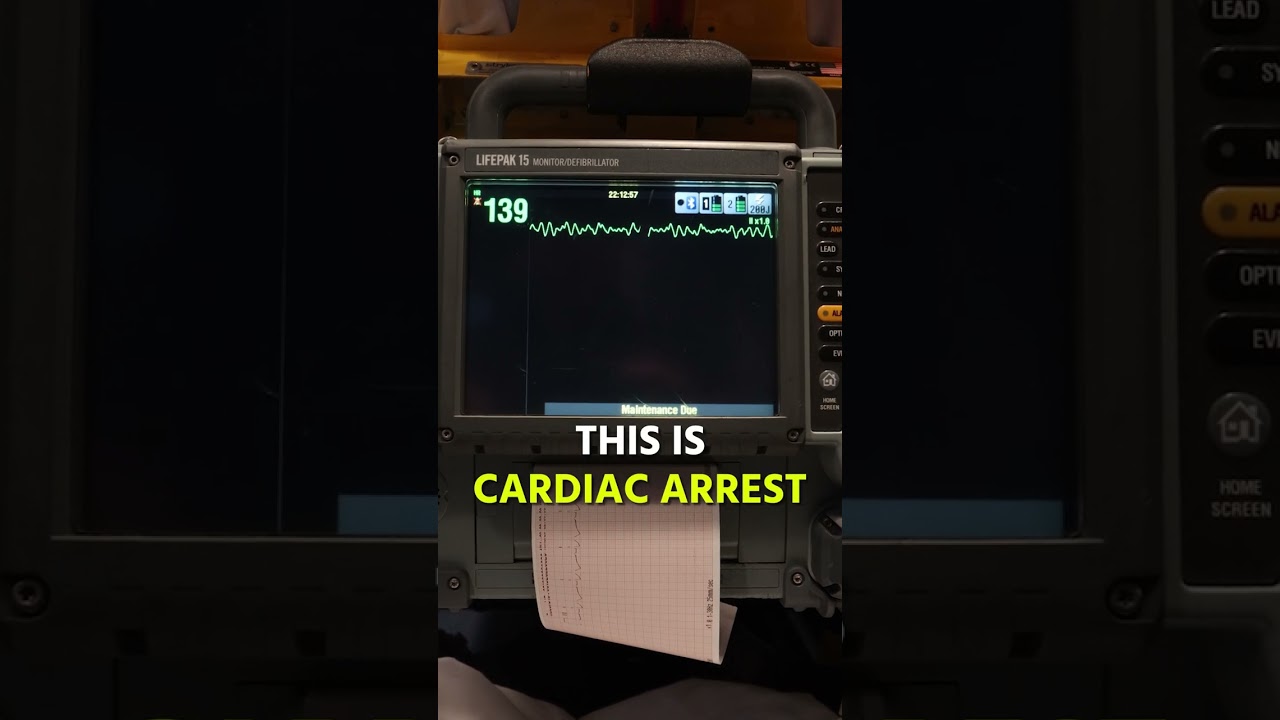 Ventricular Tachycardia to Fibrillation