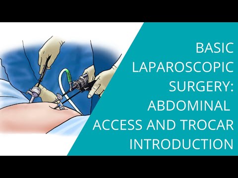 Basic Laparoscopic Surgery: Abdominal Access and Trocar Introduction