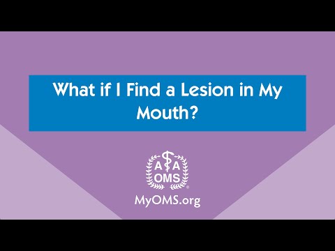 What if I Find a Lesion in My Mouth?