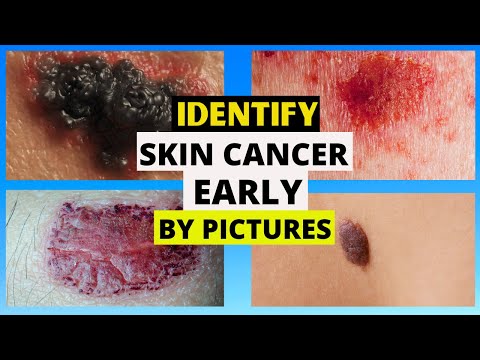 Skin Cancer Pictures Early Stages | Types | Melanoma | ABCDE Criteria | Prevention