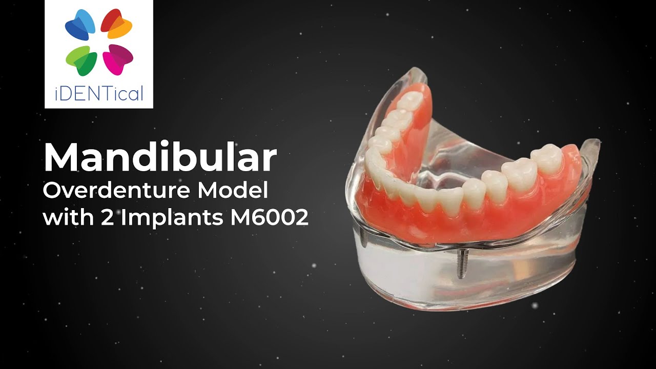 iDENTical Mandibular Overdenture Model with 2 Implants M6002