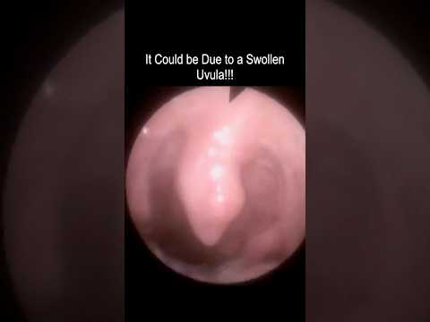 Swollen Uvula Causing Lump Sensation in Throat #shorts #throatlump #globus @fauquierent