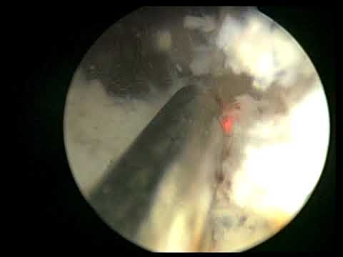 Holmium Laser Ablation of Prostate (HoLAP)