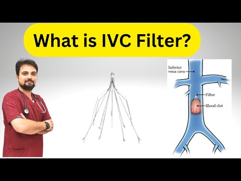 IVC Filter: What You Need to Know
