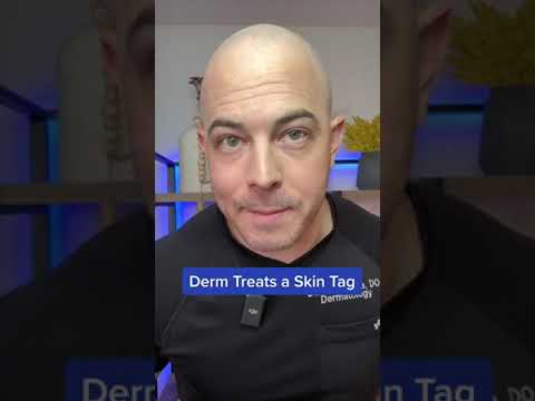 Doctor removes his own skin tag! #skintag #skintagremoval #dermreacts