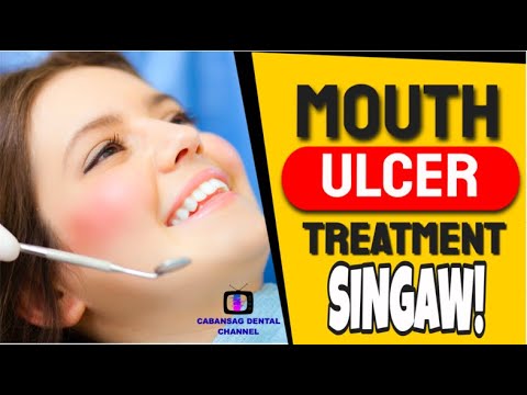 Mouth Ulcer: Canker Sore| Aphthous Ulcer|Prevention| Singaw| mouth Ulcer Treatment( Fast) 2021