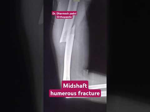 Midshaft humerous fracture-platting (Isolating radial nerve)#trauma#doctorvlog #shortsviral#trending