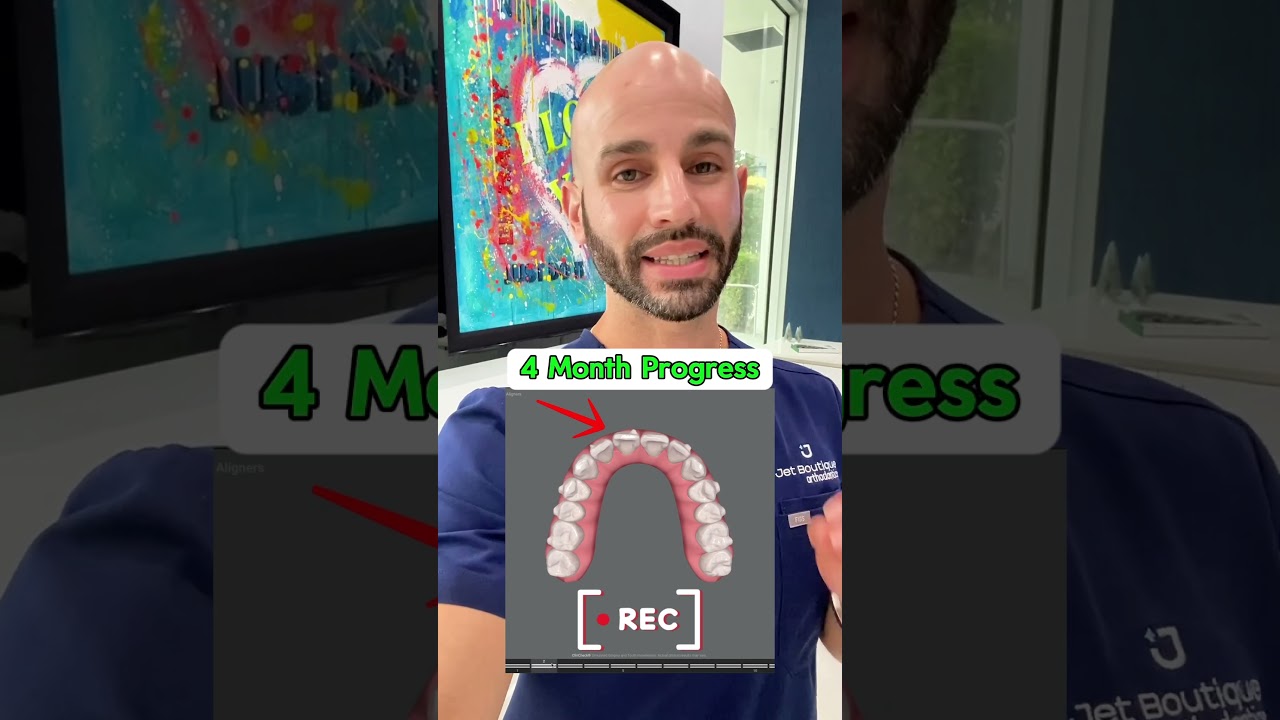 Can I Fix My Overcrowded Front Teeth with Invisalign and Without Extractions?