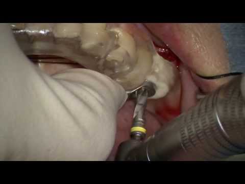 Straumann implant 2.8mm drilling & bone graft with guided surgery system