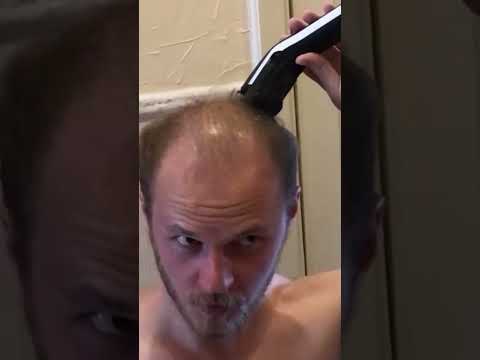 BALDING IN MY 20's Head Shave BEFORE/AFTER
