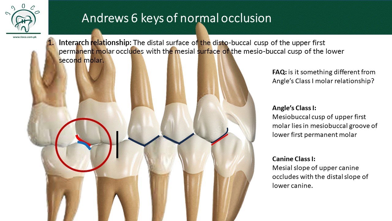 Andrew's 6 Keys of Normal Occlusion (Lesson 1 (1st key) )