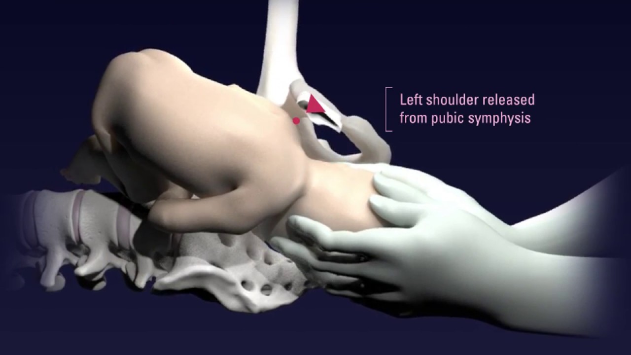 Shoulder dystocia delivery
