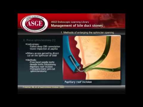 Endoscopic Retrograde Cholangiogram for Benign Biliary Diseases (DV044)