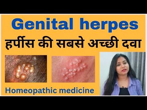 Genital herpes treatment !! Genital herpes symptoms,causes & homeopathic medicine in hindi !!