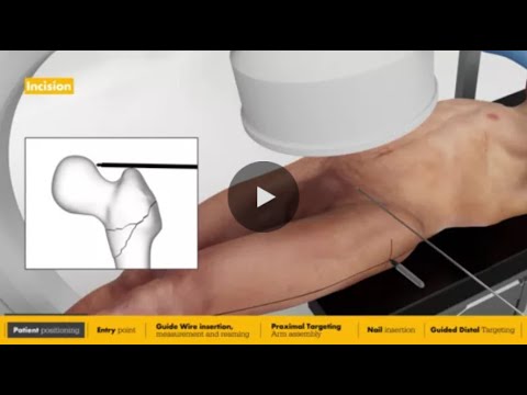 Long Nail surgical animation | Gamma4 Hip Fracture Nailing System