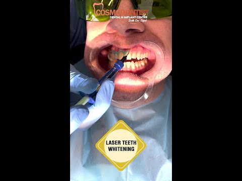 Laser Teeth Whitening