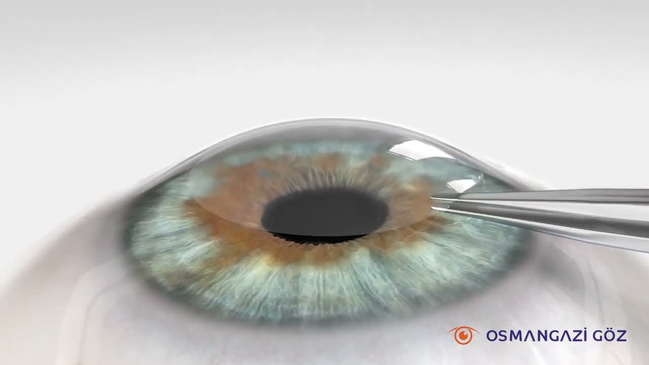 Doç. Dr. Bulent KOSE | Göz Doktoru - DOÇ. DR. Bülent KÖSE