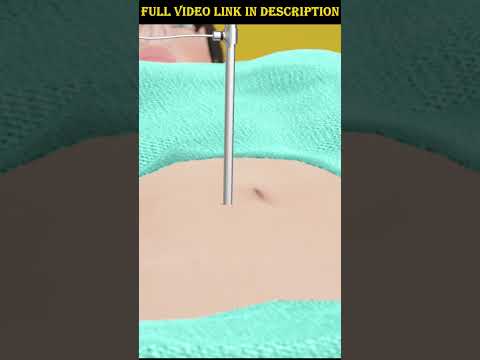 महिला नसबंदी | Female Sterilization Explained in 3D Animation #shorts #viral #biology