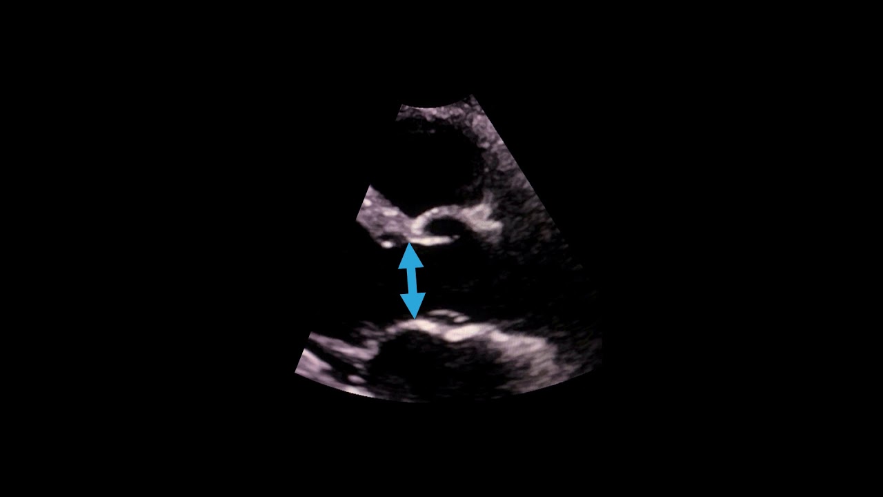 Calculating the aortic valve area