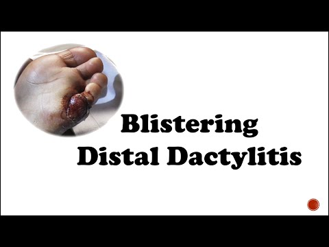 Blistering Distal Dactylitis