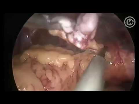 Disseminated (Parasitic) Peritoneal Leiomyomatosis Following Laparoscopic Myomectomy