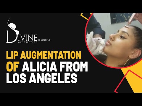 Lip Augmentation of Alicia from Los Angeles
