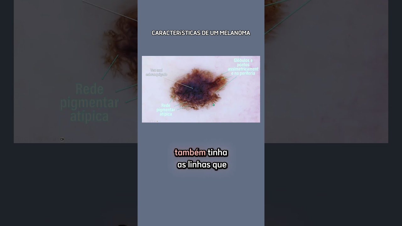 Características do melanoma na dermatoscopia. #melanoma #dermatoscopia #dermatologista #skincancer