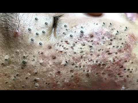 ASMR Pimple Popping Video for a Peaceful and Cleansing Mind