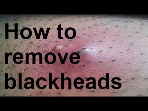 Causes and how to treat blackheads#blackheads