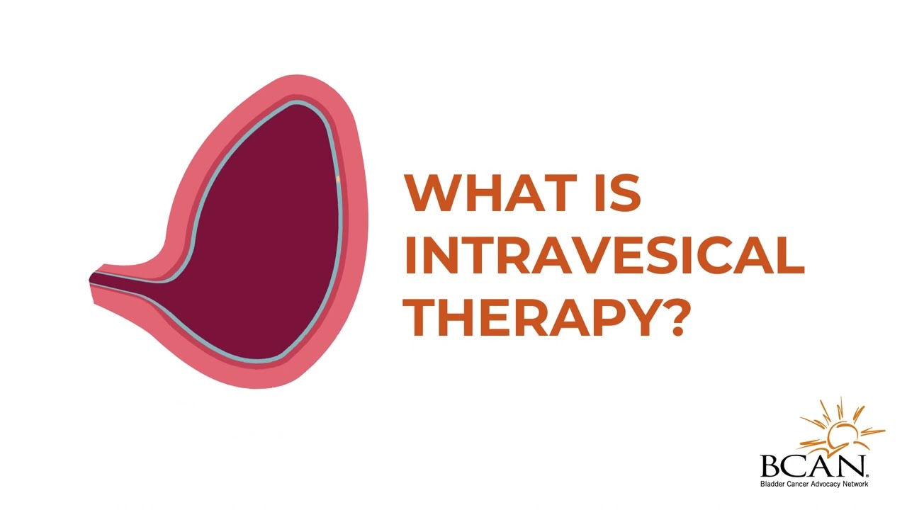 What is Intravesical Therapy? | Bladder Cancer Advocacy Network