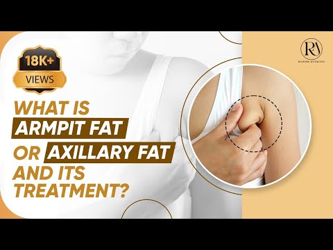Armpit Fat Removal Surgery: Underarm Liposuction for Axillary Breast