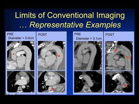 Imaging Marfan Patients – When and How