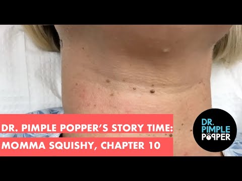 Watch Dr. Pimple Popper Snip Skin Tags and Pop Buttery Cysts